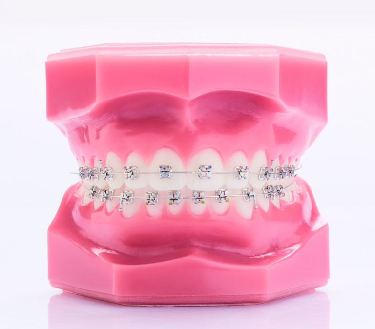 Fixed Braces - Kieferorthopädisches Zentrum Zürich